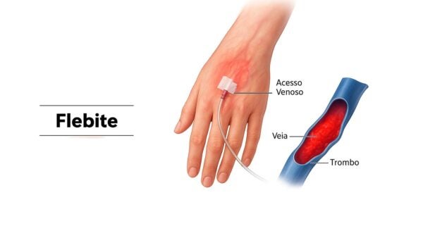 Flebite em hospitais do Brasil: o problema invisível que compromete o ...